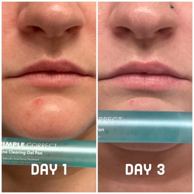 Hero Cosmetics Pimple Correct Acne Clearing Gel Pen - 0.34 Fl Oz : Target