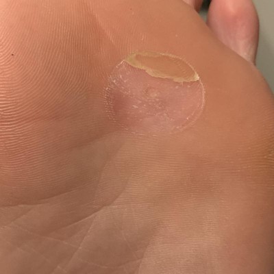 Dr. Scholl's Callus Removers Seal & Heal Bandage With Hydrogel ...