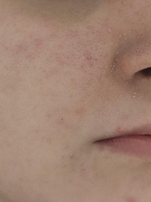 Neutrogena Oil Free Pink Grapefruit Acne Face Wash With Vitamin C For ...