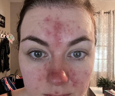 Cerave Acne Foaming Cream Face Cleanser, Acne Treatment Face Wash ...