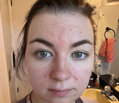 Cerave Acne Foaming Cream Face Cleanser, Acne Treatment Face Wash ...