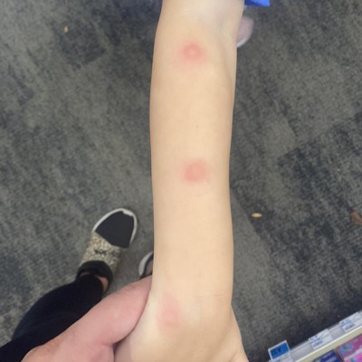 Bug Bite Thing Insect Bite + Sting Suction Tool - 1ct : Target