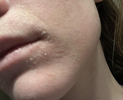 Max. Strength Acne Medication - 1oz - Up & Up™ : Target