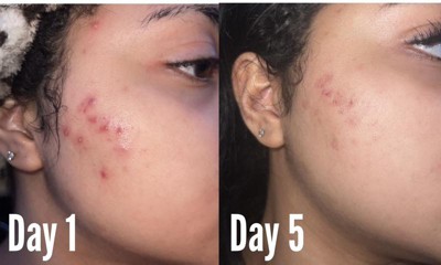 Max. Strength Acne Medication - 1oz - Up & Up™ : Target