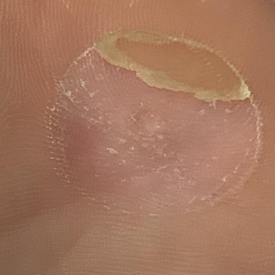 Dr. Scholl's Callus Removers Seal & Heal Bandage With Hydrogel ...