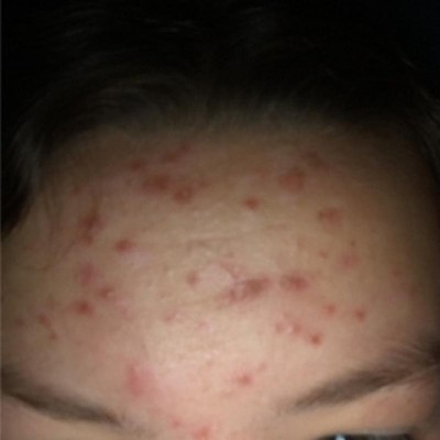 Proactiv Solution 30 Day Acne Treatment Kit - 5 Fl Oz/3pc : Target