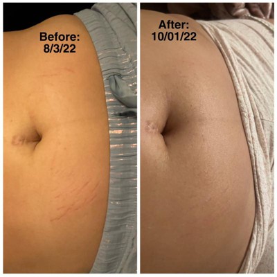 Bio-oil Skincare Oil For Scars And Stretchmarks, Serum Hydrates Skin ...