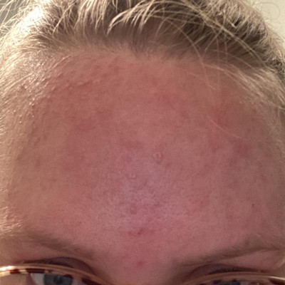 Max. Strength Acne Medication - 1oz - Up & Up™ : Target