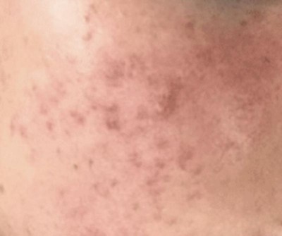 Acne Spot Treatment .75oz - Up & Up™ : Target