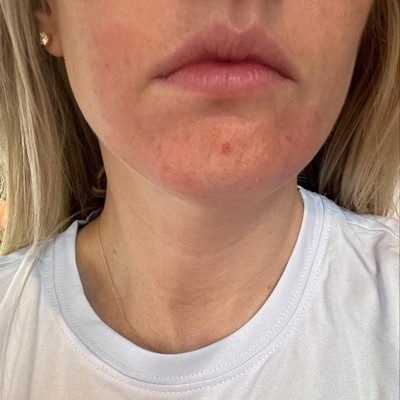 Acne Spot Treatment .75oz - Up&up™ : Target