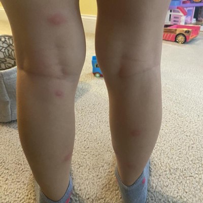 Bug Bite Thing Insect Bite + Sting Suction Tool - 1ct : Target