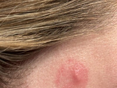 Differin Acne-prone Skin Patches With Salicylic Acid - 36ct : Target