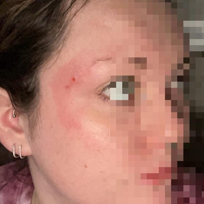 Max. Strength Acne Medication - 1oz - Up & Up™ : Target