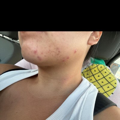 Differin Maximum Strength Acne Foam Face And Body Cleanser 10% Bpo - 5 Fl Oz : Target